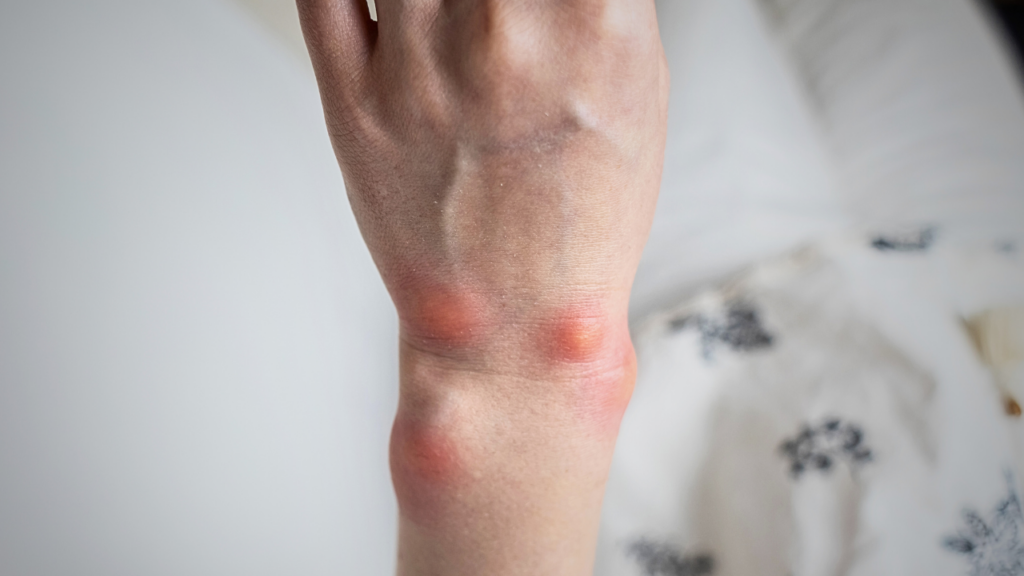 6 Most Common Causes Of Itchy Bumps On Skin - Femhealth Cares